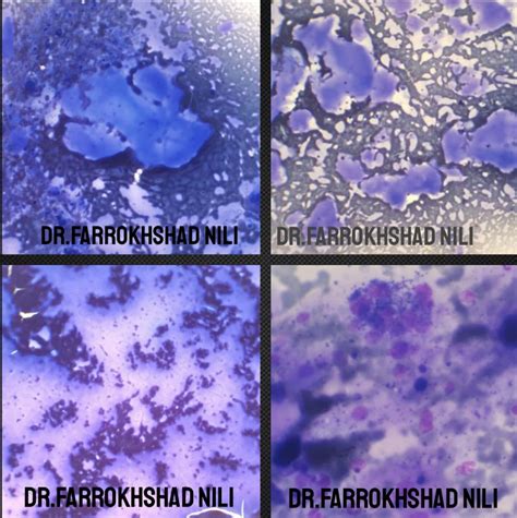 Farrokhshad Nili On Linkedin Fine Needle Aspiration Of Thyroid Nodule