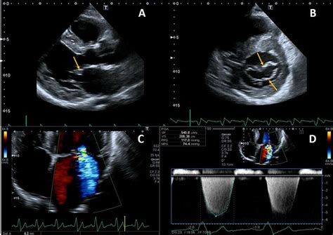 Example Of Valvular Heart Involvement In Fabry Cardiomyopathy A B