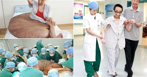 Man Has World S Biggest Tumour Weighing Lbs Removed From His Back World News Mirror Online