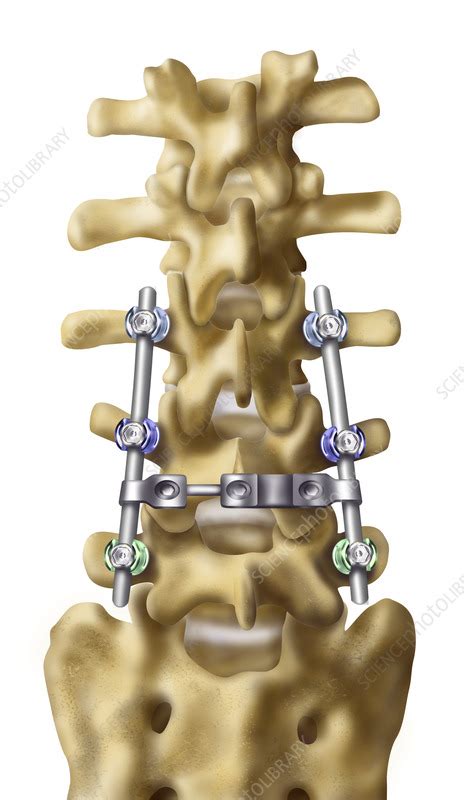 Spinal Surgery Illustration Stock Image C061 2190 Science Photo