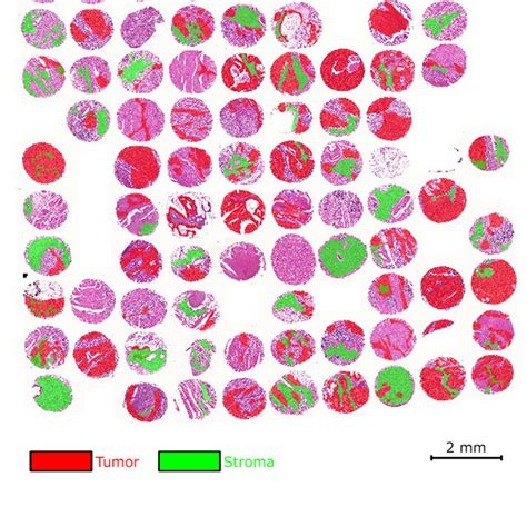 Regions Of Interests Virtual Microdissection Separating Tumor Cells