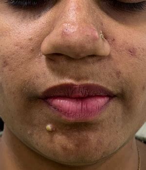 How To Get Rid Of Pus Filled Pimples Treat Pimples With Pus