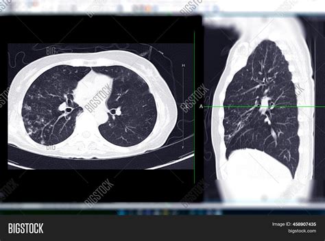 Ct Chest Ct Scan Lung Image And Photo Free Trial Bigstock