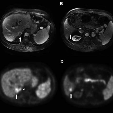Clinical Mplications Of Dual Tracer Pet Ct Pet Ct Positron Emission