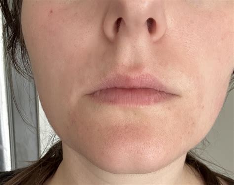 Perioraldermatitis