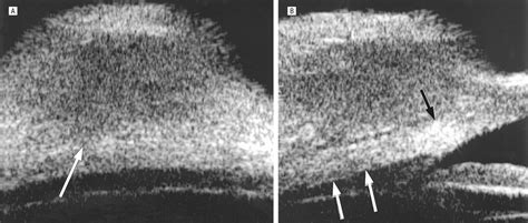 Patient 10 Transverse A And Longitudinal B Sections Of A 50 Mhz