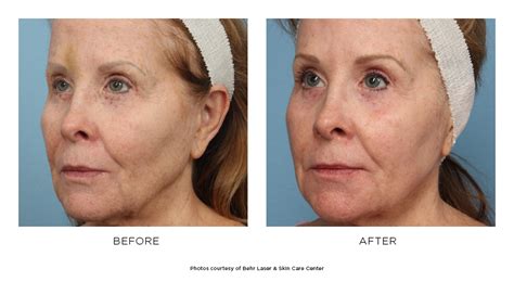 Active Fx™ Skin Resurfacing Fresno Behr Laser And Skin Care Center