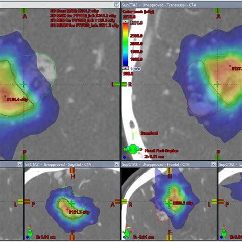 Dose Distributions For Patient 3 From The Avm‐vmat Volume‐staged Plans Download Scientific