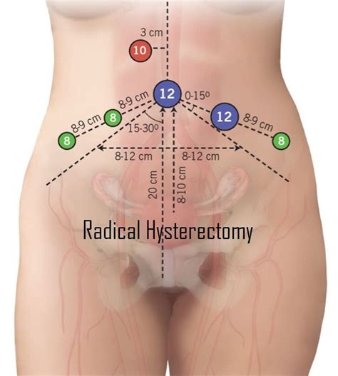 Port Position Of Various Robotic Genaecological Surgeries