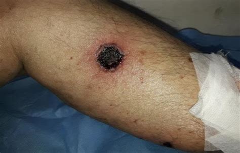 A Large Hemorrhagic Blister In Vasculitis Download Scientific Diagram