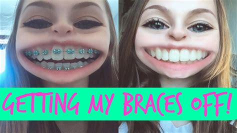 Getting My Braces Off Vlog Youtube Getting My Braces Off Vlog Youtube