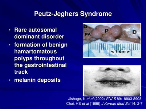 Peutz Jeghers Syndrome And Mutation In Stk Gene Causes Diagnosis The
