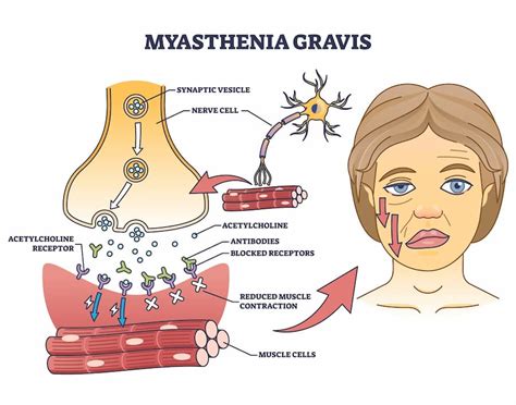 Myasthenia Gravis Treatment With Stem Cells Swiss Medica