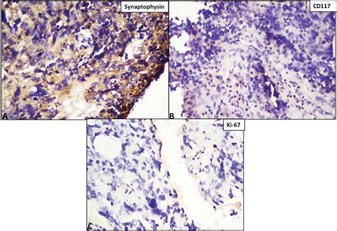 Immunohistochemical Stain Synaptophysintumor Cells Displaying