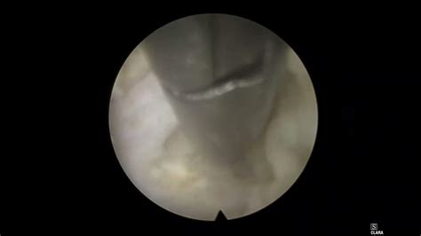 Endoscopic Interlaminar Discectomy L5s1 Left Youtube