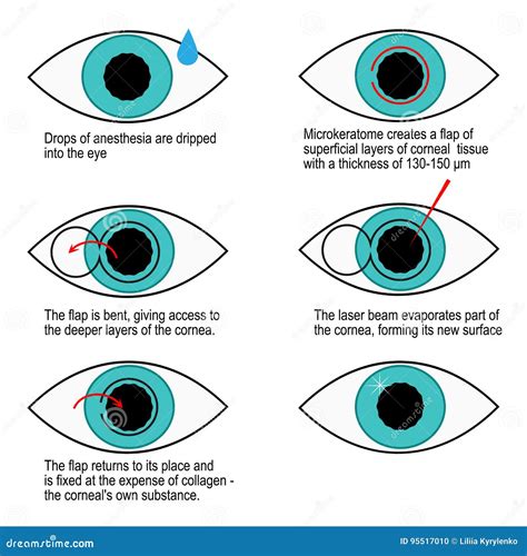 Procedure Of Laser Correction Of Vision Step By Step Infographics