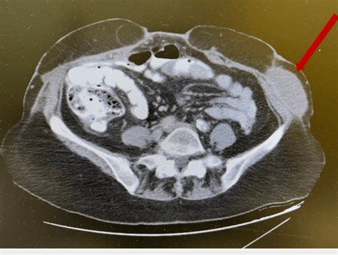 Ct Scan Showing Abdominal Wall Abscess And Necrosis Abdominal Wall