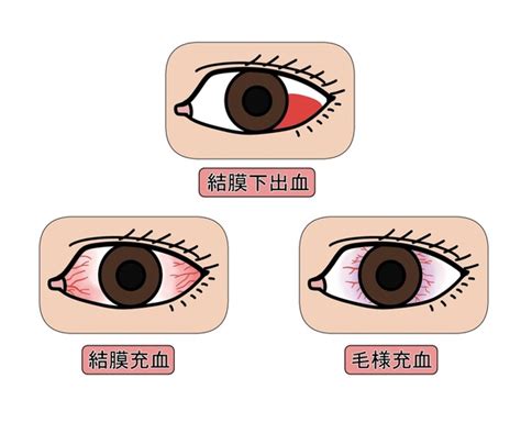 2 Conjunctival Hyperemia Royalty Free Photos And Stock Images