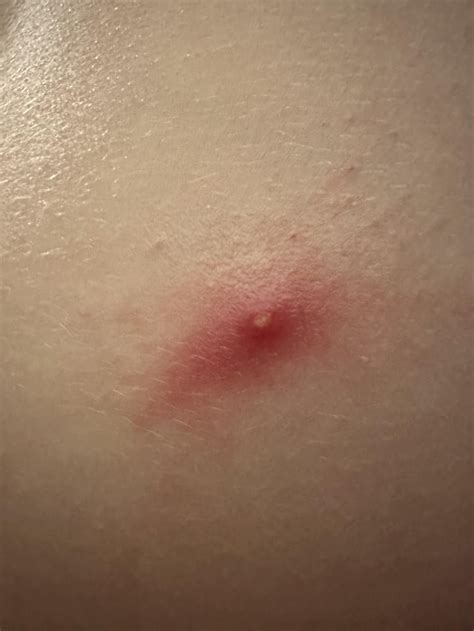 Spiderbug Bite Or Pimple Rbugbites