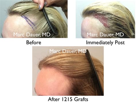 Female Hair Transplant Results Marc Dauer Md Hair Transplant Doctor