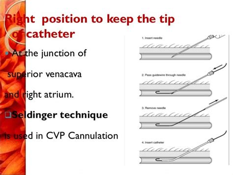 Cvp Line
