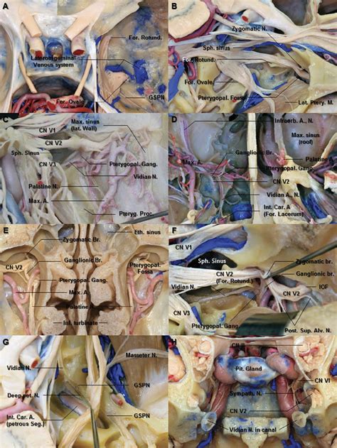 Views Of The Middle Fossa Trigeminal Nerve And Pterygopalatine Fossa