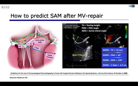 The Risk For Sam Systolic Anterior Motion In Patients Undergoing