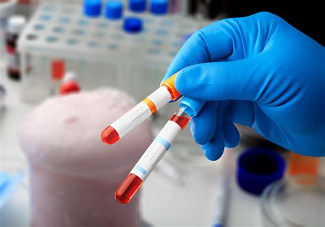 Che Cosè La Leucemia Mielomonocitica Cronica Health Online