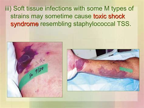 Streptococcus And Enterococcus By Dr Rakesh Prasad Sah Pptx