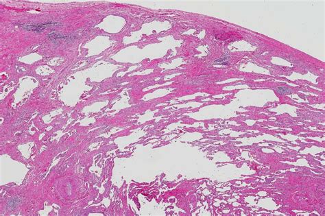 50 Facts About Idiopathic Diffuse Interstitial Fibrosis Facts Net