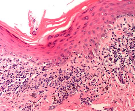 Lichen Planus Wikipedia