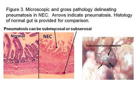 Ischemic Colitis Vs Necrotizing Enterocolitis At Henry Lymburner Blog