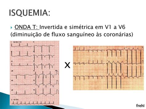 PPT Eletrocardiograma Noções básicas PowerPoint Presentation free