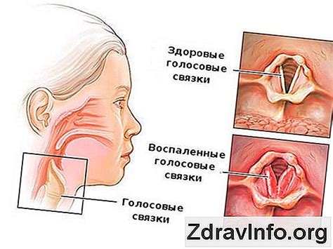 Tablety Z Hrtanu U Dospělých Indikace A Kontraindikace 👃 Portál Sinus A Další 2025