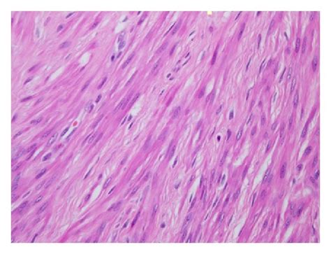 High Power View Of The Ovarian Leiomyoma Composed Of Interlacing