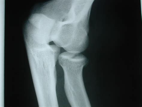 Unidad Cirugia De Mano Y Reconstructiva La Plata Argentina Fractura De