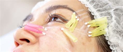 Pdo Threads Under Eyes Before And After Results Yastrid Medical