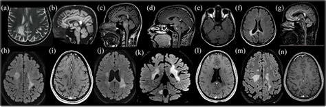 Radiological Characteristics Of Two Patients Presented With Tumefactive