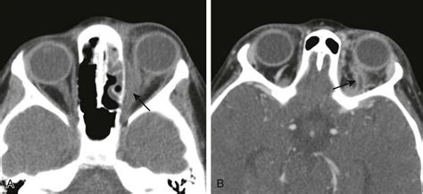 Orbit Infection And Inflammation Radiology Key