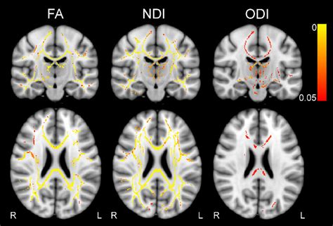 Results Of Tract Based Spatial Statistics Analyses Color Bar Indicates