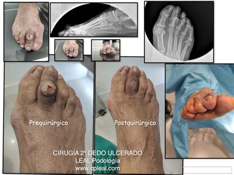 Tratamiento para dedos en garra y martillo Cirugía o plantillas