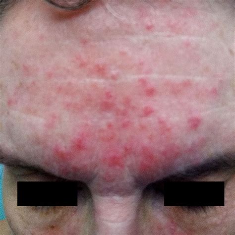 Treating Rosacea Combination Therapy Benzoyl Peroxide And The ‘stop