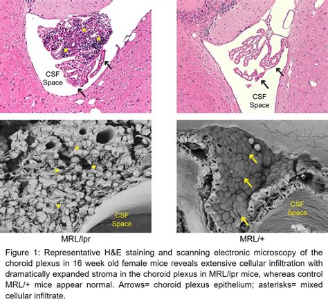 Choroid Plexus Tertiary Lymphoid Structures In Lupus A Novel Neuro