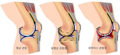 슬개골 연골연화증 소생한의원