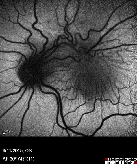Combined Hamartoma Of The Retina And Rpe Retina Image Bank