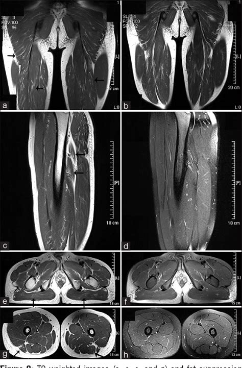 Myopathy With Abnormal Lipid Metabolism Semantic Scholar