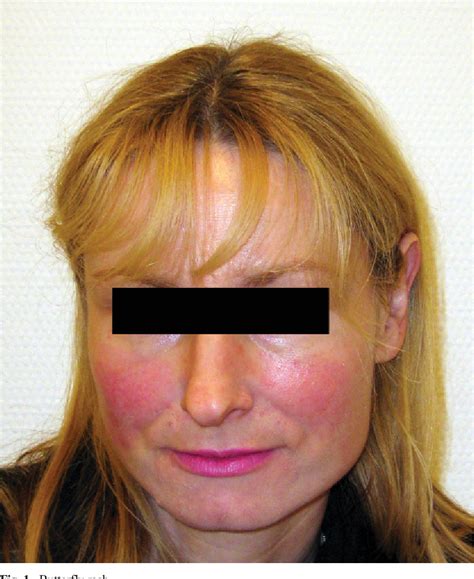 Figure From Viral Haemorrhagic Fever And A Skin Rashwhat Is The Link Semantic Scholar