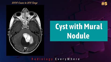 Spiculated Nodule Radiology At Bridget Mireles Blog