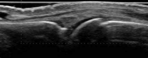 Musculoskeletal Joints And Tendons 64 Fingers Case 641