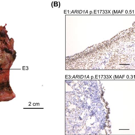 Arid1a Protein Expression In Ovarian Endometriosis Endo3 A